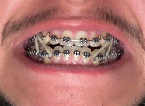 Amazing Non Surgical Underbite Correction Braces 1 Year R Braces
