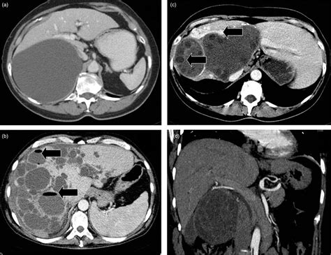 Figure 4 From Surgical Management Of Cystic Lesions In The Liver