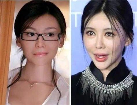 明星整容后遗症整容的脸能维持多少年 整容后遗症面部浮肿怎么解决 娱乐动态