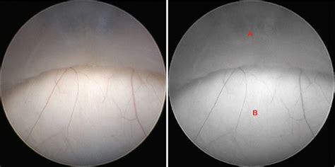 Lamina Terminal Terceiro Ventriculo