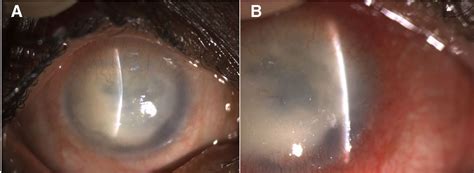 Phacolytic Glaucoma