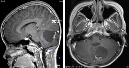 Pilocytic Astrocytoma Radiology Cases