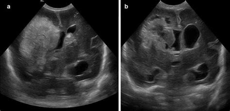 Intraventricular Hemorrhage Ultrasound