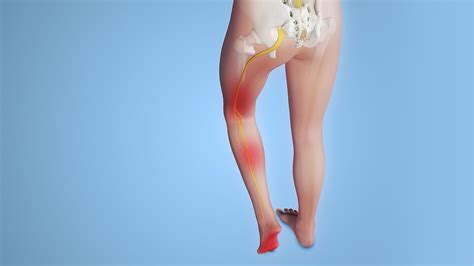 Sciatica Causes Pathophysiology Management And Treatment
