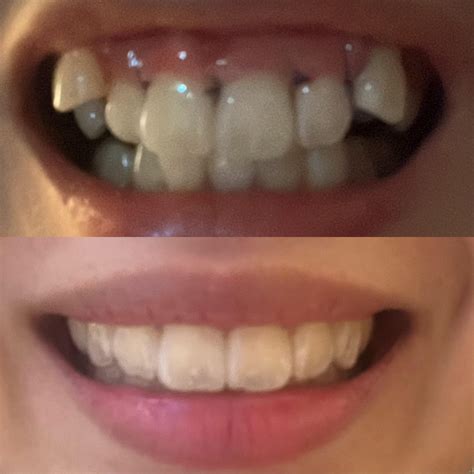 My Ortho Wants To Extract My Wisdom Teeth But I Dont Like That Idea Please Share Your