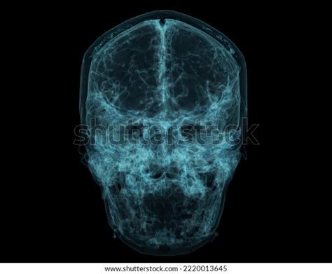 인간 두개골 Ct 스캔의 뇌 두개골 스톡 일러스트 2220013645 Shutterstock