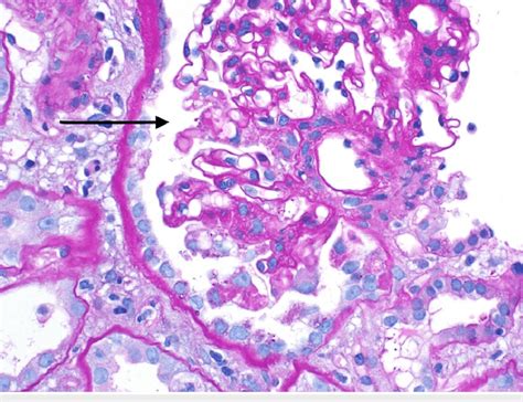Arrow Showing Glomerular Sclerosis Download Scientific Diagram