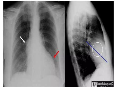 Cxr Of Common Heart Pathology Agp Ppt