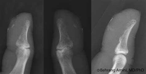 Roentgen Ray Reader Pyogenic Granuloma And Silver Nitrate