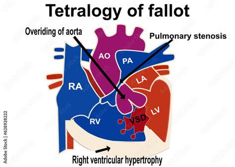The Picture Show The Structure Of Tetralogy Of Fallot That Show The 4
