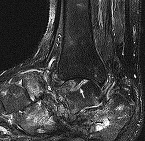 Avascular Necrosis Of The Talus A Pictorial Essay Radiographics