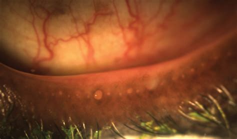 Mgd Not Unusually Common In Pregnant Women