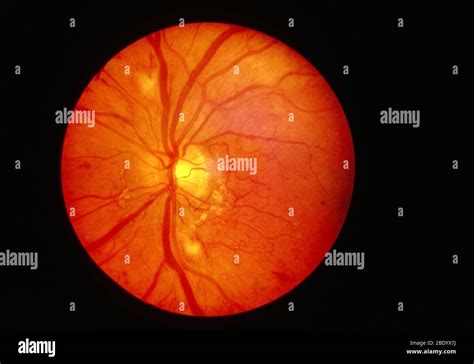 Central Retinal Artery Anatomy