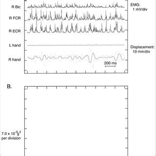 PDF Tremor Clinical Phenomenology And Assessment Techniques