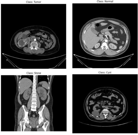 논문 리뷰 A Novel Ensemble Based Deep Learning Model With Explainable Ai