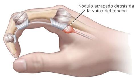 Dedo En Resorte Dedo En Gatillo Tenosinovitis Estenosante Cirugia