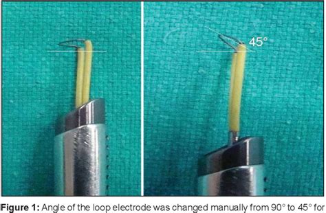Figure 1 From Is En Bloc Transurethral Resection Of Bladder Tumor For