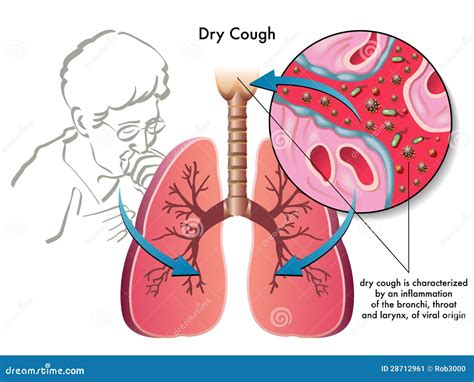 Dry Cough Stock Image Image 28712961