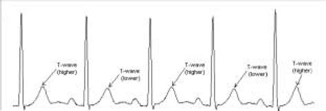 A Fragment Of An Ecg With Observable T Wave Alternans Download Scientific Diagram