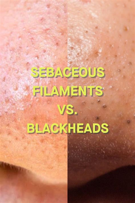 Sebaceous Filaments Vs Blackheads Whats The Difference Sebaceous