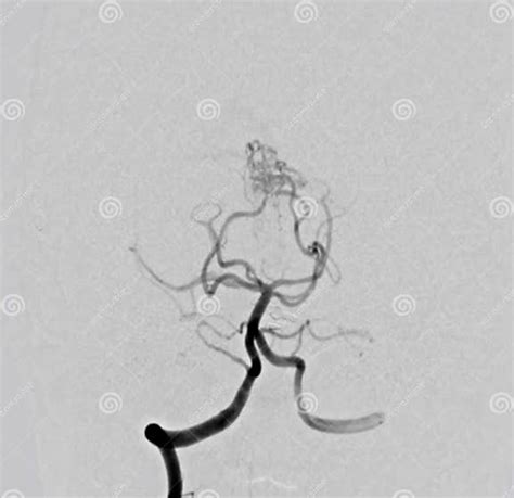 A Cerebral Angiogram Is A Medical Imaging Procedure Used To Examine