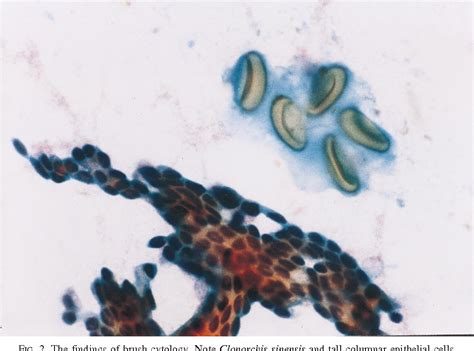 Figure 2 From Biliary Papillary Hyperplasia With Clonorchiasis