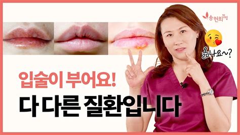 입술이 붓는 질환 구순염 Vs 맥관부종 Vs 헤르페스 감별이 필요한 이유 Youtube