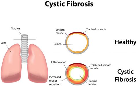 What Factors Affect Life Expectancy With Cystic Fibrosis