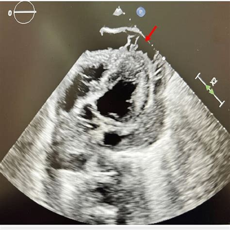 Electrocardiogram On Initial Presentation The Image Shows Diffuse St Download Scientific