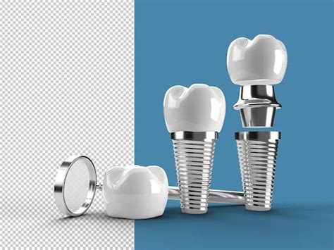 مدت زمان کاشت ایمپلنت مقالات دکتر میلاد محمدی