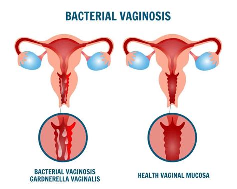 Vaginal Infections Causes Symptoms Treatment