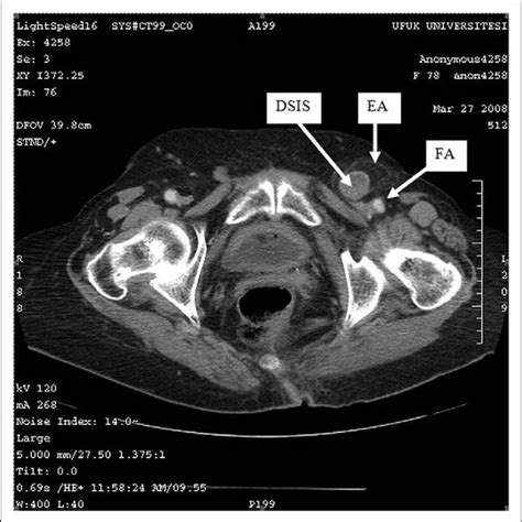 A Laparoscopic View Of A Gangrenous Appendix Epiploica On The Surface