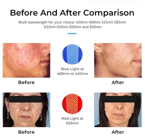 Full Laser Pdt Treatment Machine Omni Laser Skinology