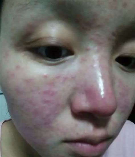 用了这个方法我的激素脸这么快就恢复正常了