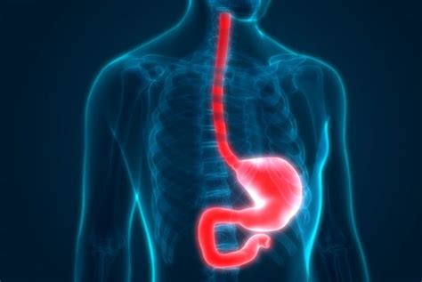 What Is Esophageal Achalasia Health And Detox And Vitamins