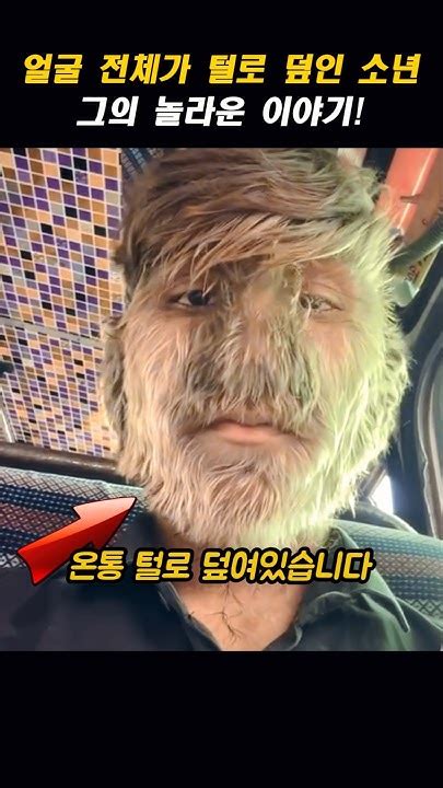 얼굴 전체가 털로 덮인 소년 그의 놀라운 이야가 Youtube
