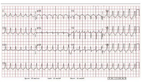 12 Lead Ekg Of The Patient With Gitelmans Syndrome Showing Monomorphic Download Scientific