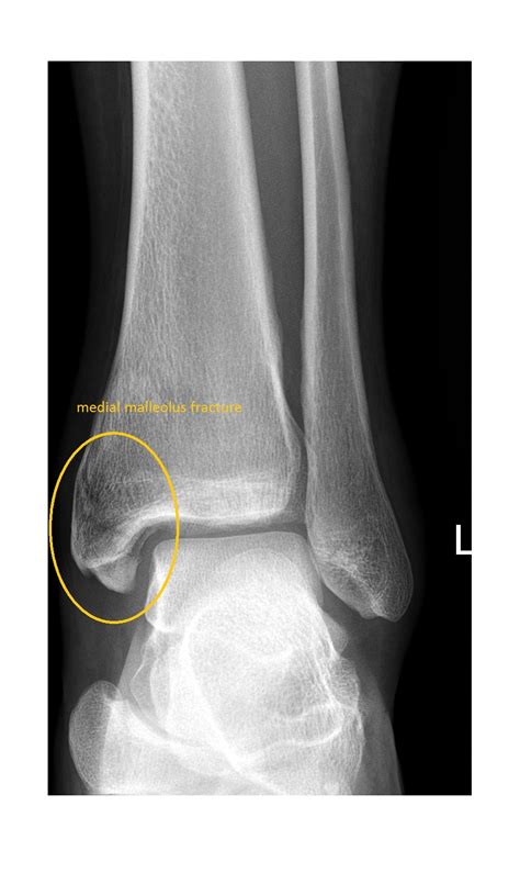 Maisonneuve Fracture Radiology