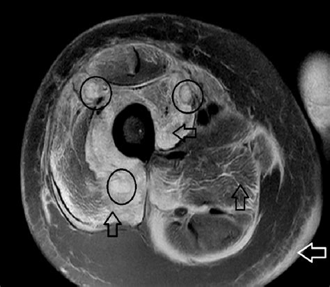Non Contrast Mri Of Right Proximal Thigh Stir Images Demonstrate