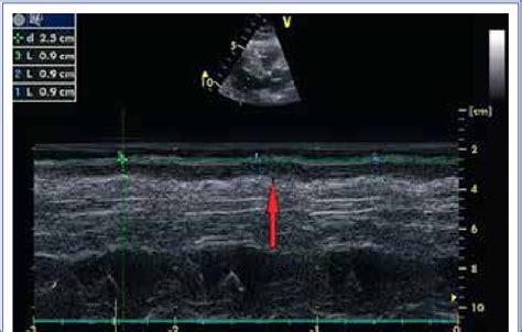 Echocardiographic Measurement Of Epicardial Adipose Tissue Thickness