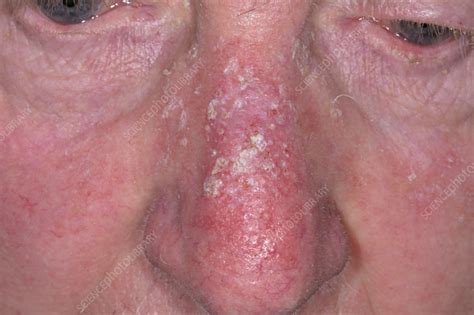 Solar Keratosis On A Mans Nose Stock Image C0585453 Science