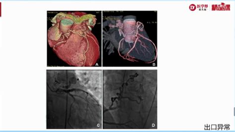 主任提问：冠脉cta有文字报告为啥还要阅片？