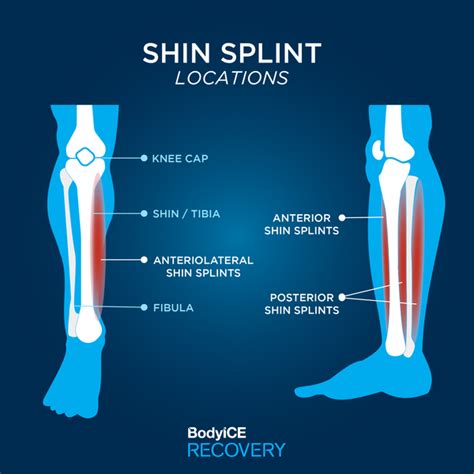 Are Shin Splints Visible On X Ray At Lachlan Legge Blog
