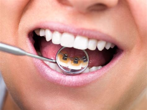 Bands To Close Teeth Gaps