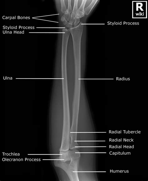 Radiographic Anatomy Of The Forearm Radiologypicscom