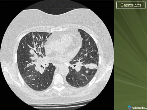Саркоидоз Портал радиологов