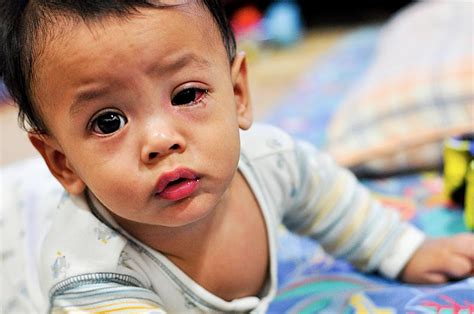 Konsep 33 Budak Sakit Mata Sebelah