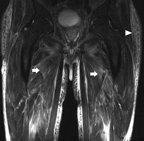 Myositis Mri