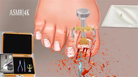 Asmr Ingrown Toenail Removal Treatment Animation Youtube