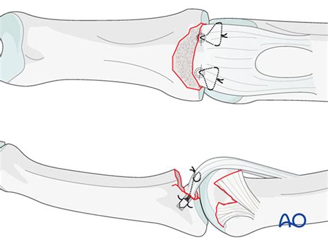 Volar Plate Hand Anatomy